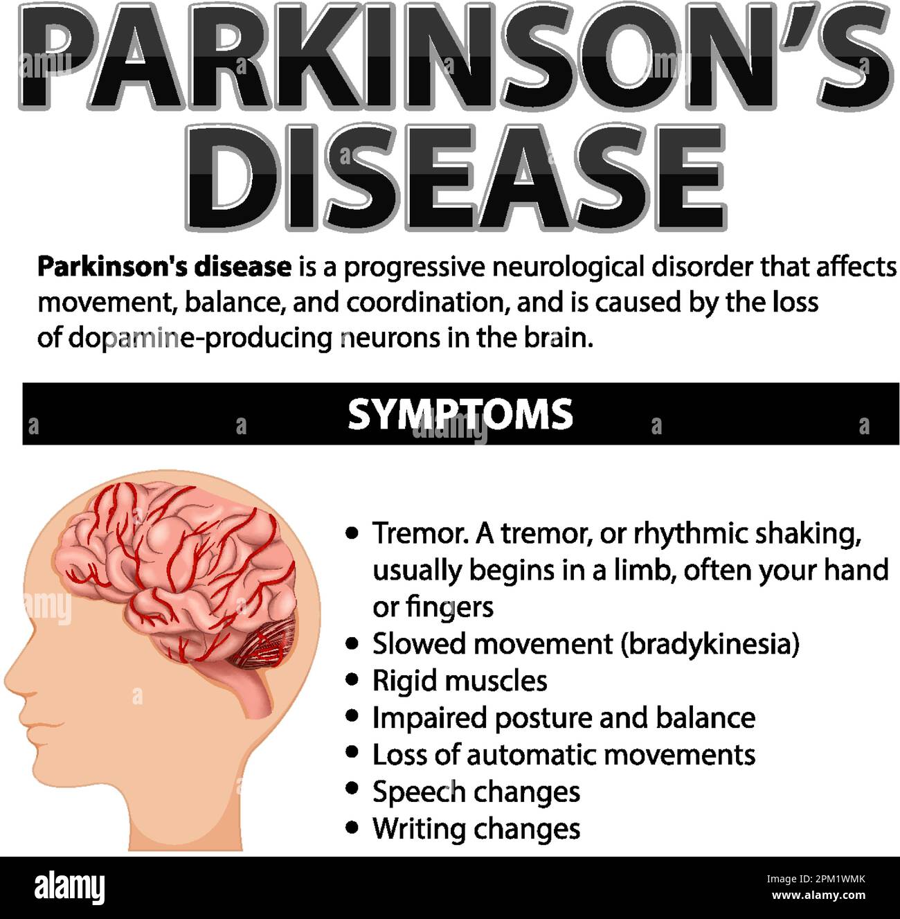 Informative poster of Parkinson disease illustration Stock Vector Image ...