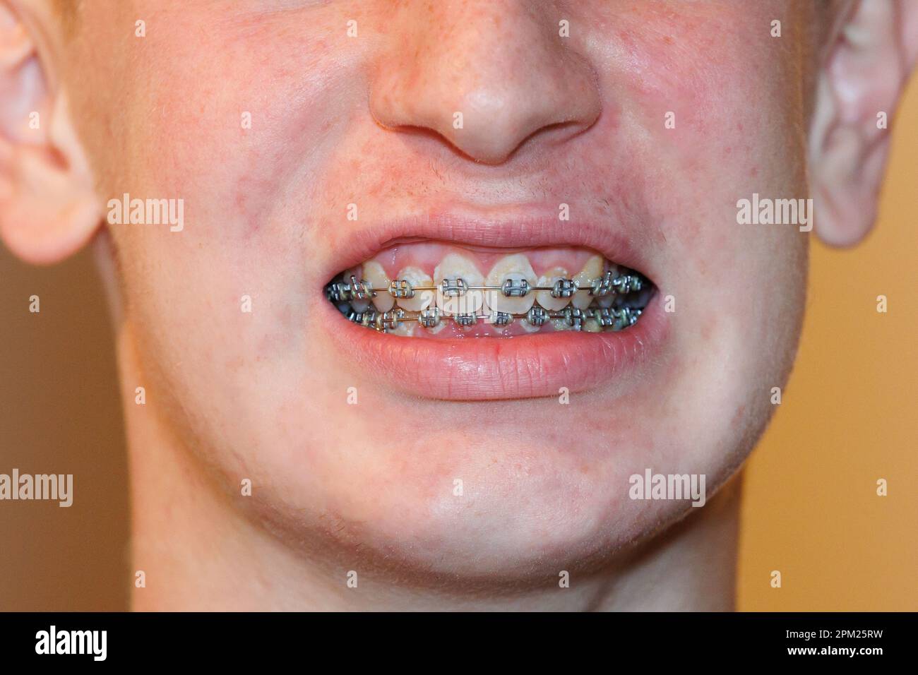 Teen Boy with Braces for Correcting Teeth Stock Photo - Alamy