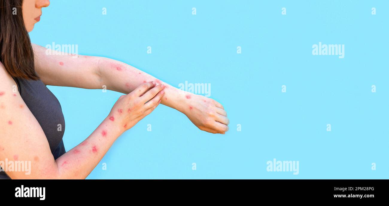 Monkeypox new disease dangerous over the world. Patient with Monkey Pox ...