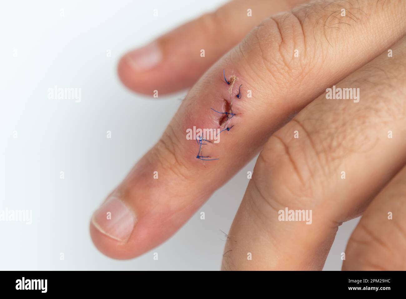 Stitched wound hi-res stock photography and images - Alamy