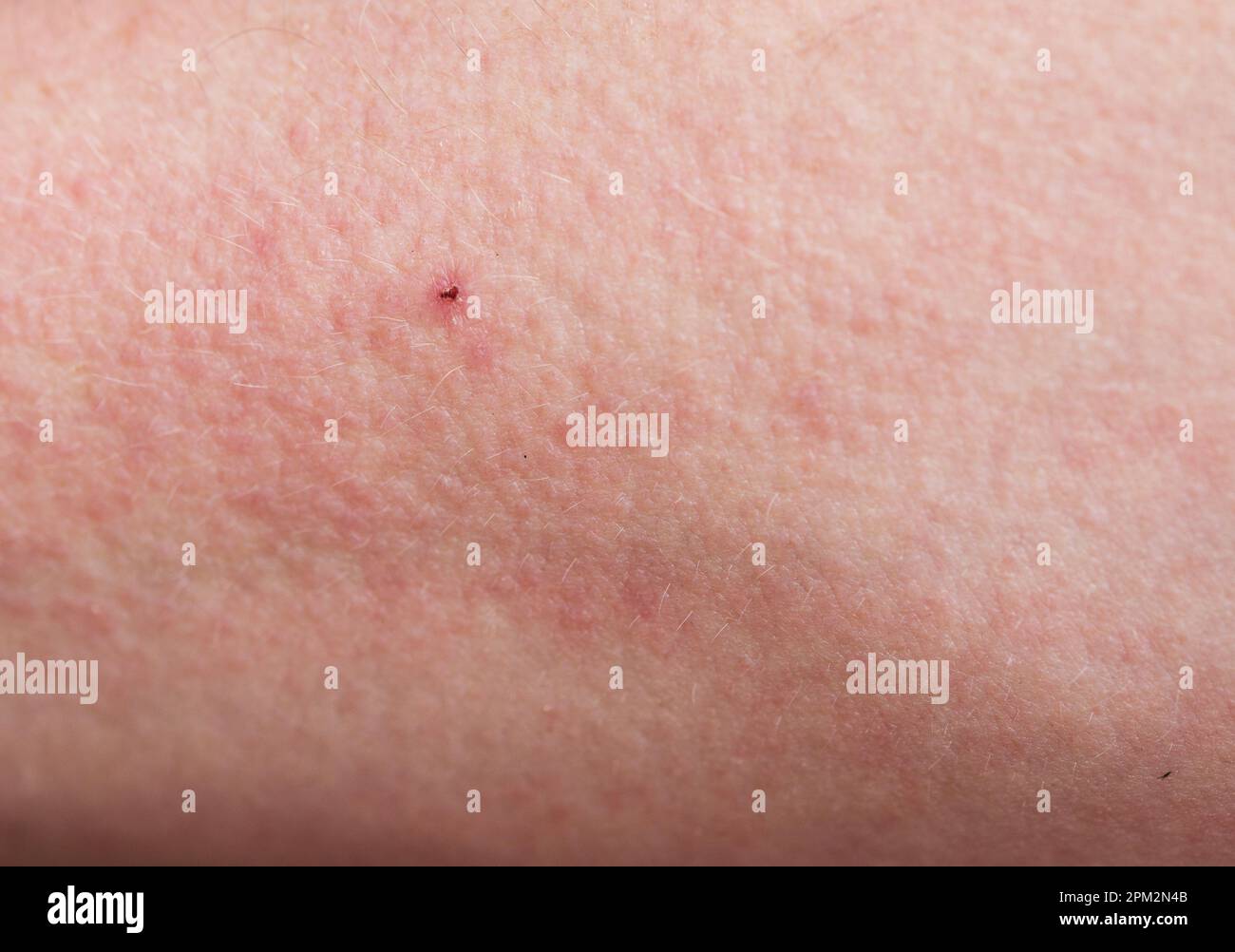 Allergic rash dermatitis skin texture Stock Photo - Alamy