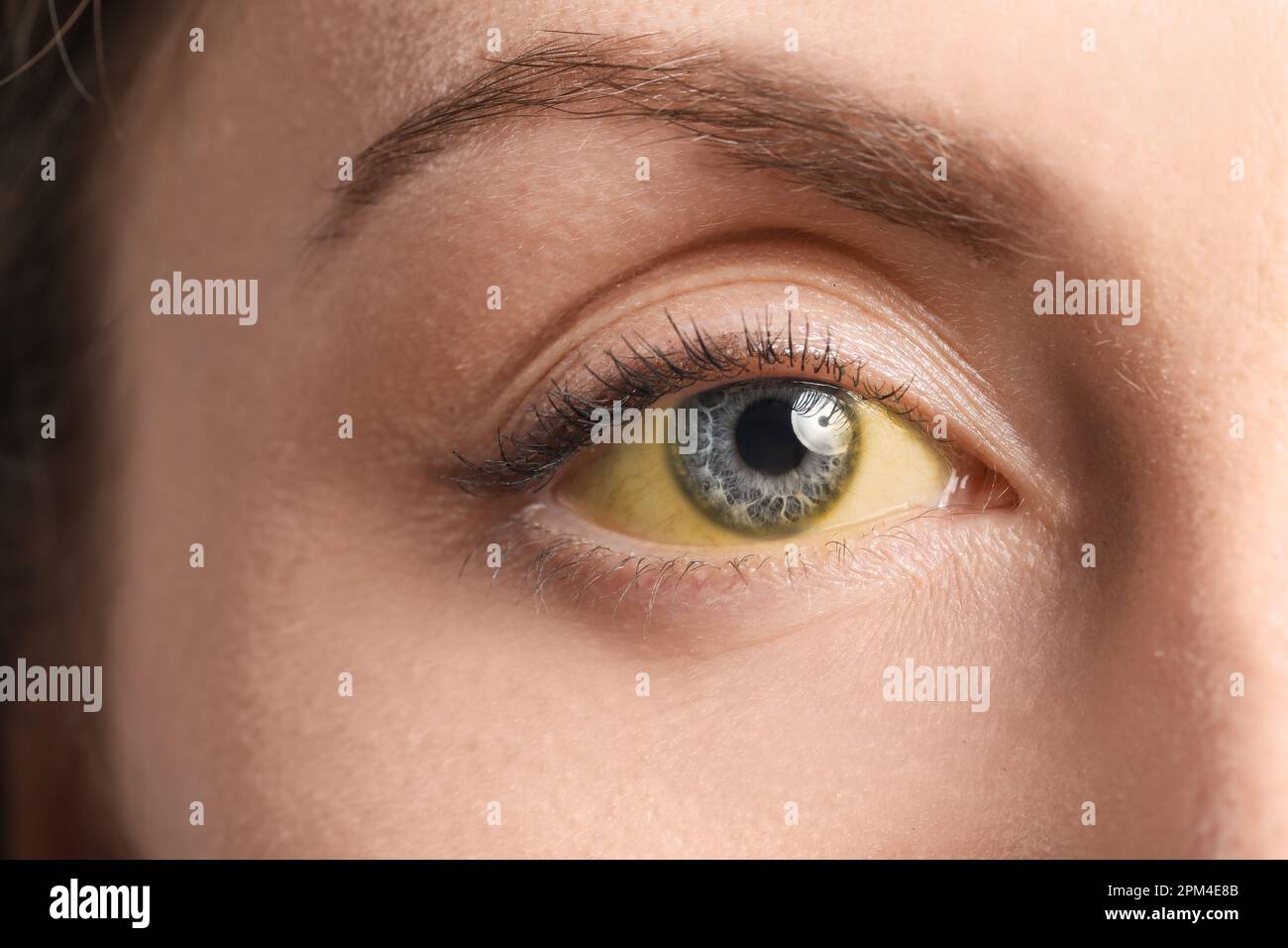 Young woman with yellow eyes, closeup. Hepatitis symptom Stock Photo ...