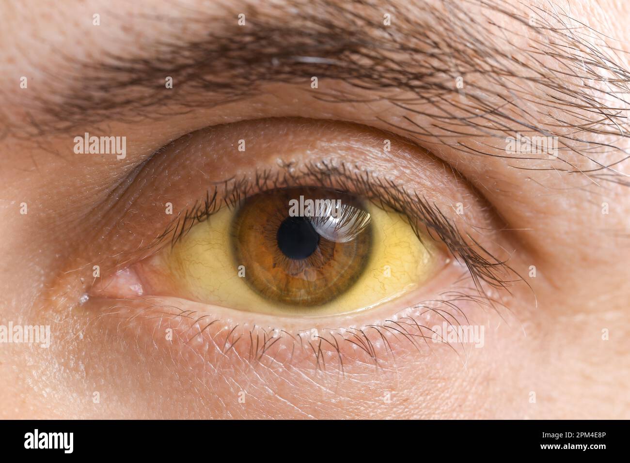 Why Yellow Eyes Symptoms at Deborah Mcgee blog