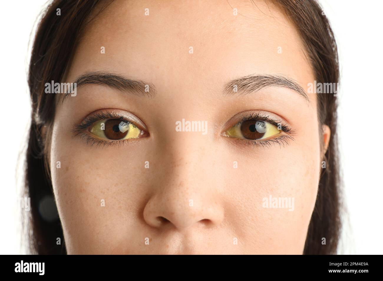 Jaundice eyes hi-res stock photography and images - Alamy