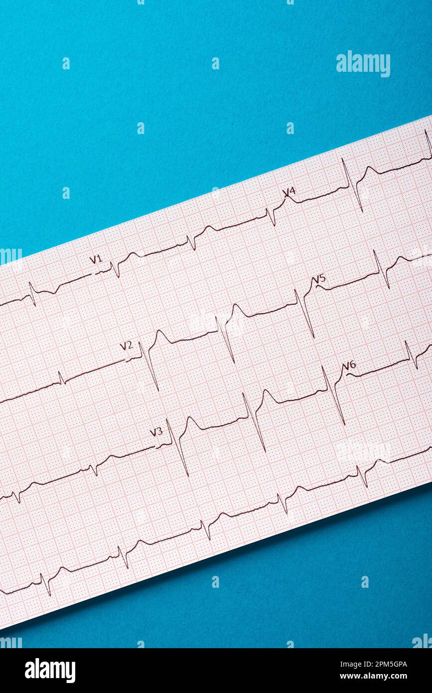 Ekg heart attack hi-res stock photography and images - Alamy