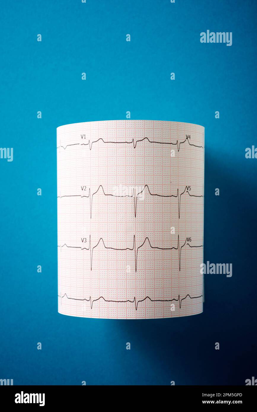 Electrocardiogram printed on paper on a blue table Stock Photo - Alamy