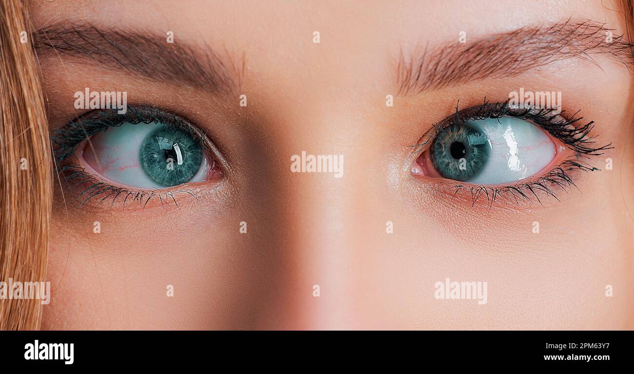 Eyes With Squinted Look And Eyebrows On Male Face Female Eyes With Strabismus Hypertropia