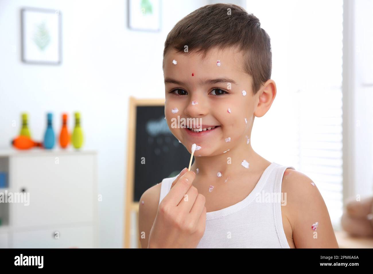 Woman applying cream onto skin of little boy with chickenpox at home ...