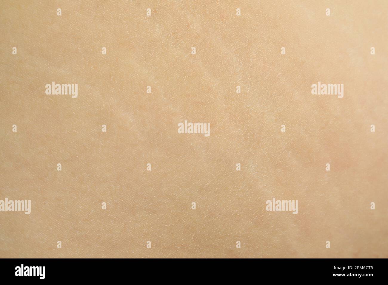 Texture of human skin with birthmark and stretch marks, closeup view ...