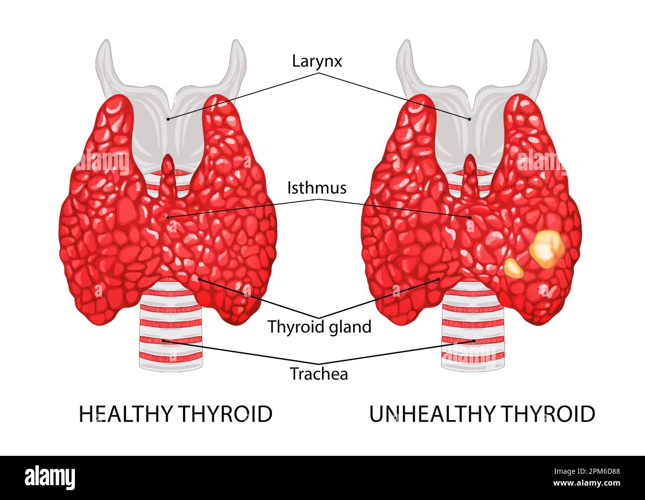 Isthmus Thyroid