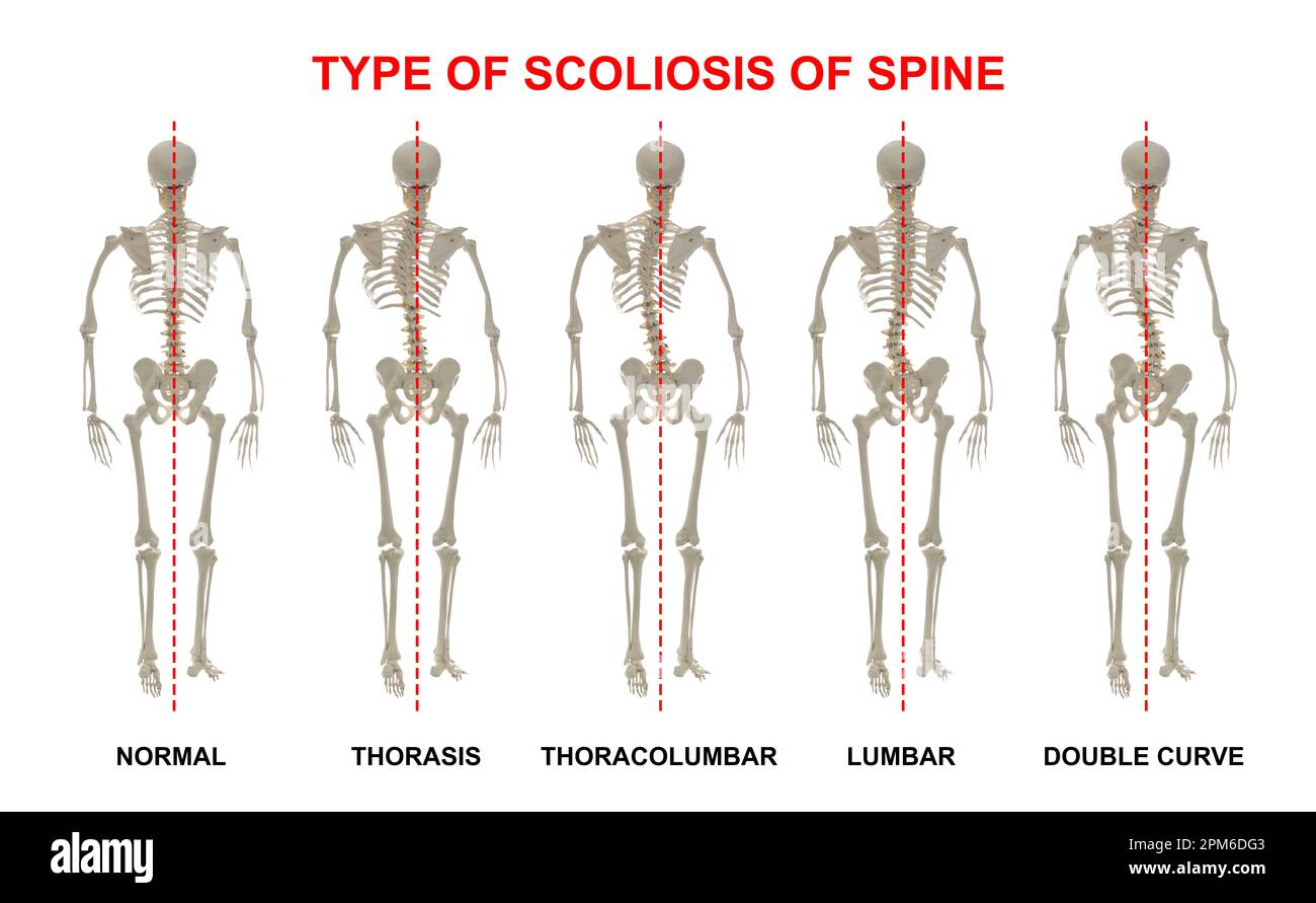 Medical poster demonstrating types of scoliosis on white background ...