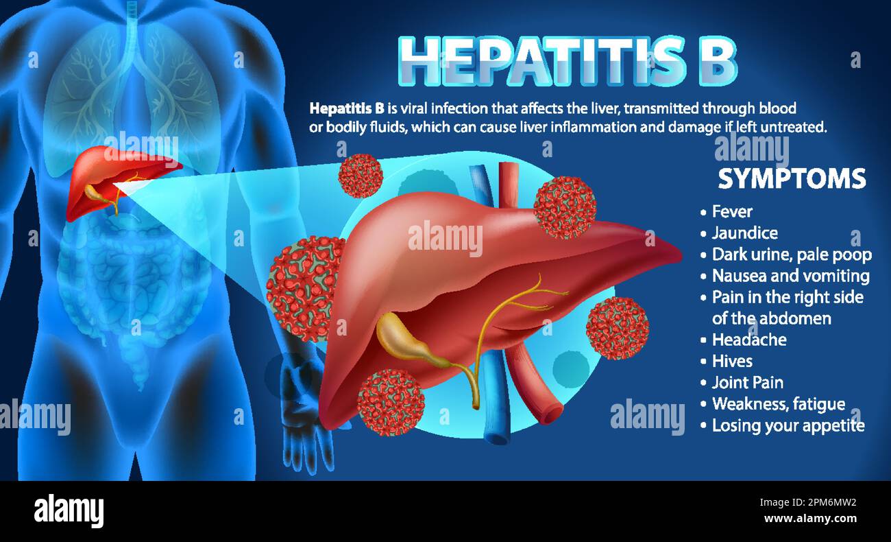 Symptoms of Hepatitis B Infographic illustration Stock Vector Image ...