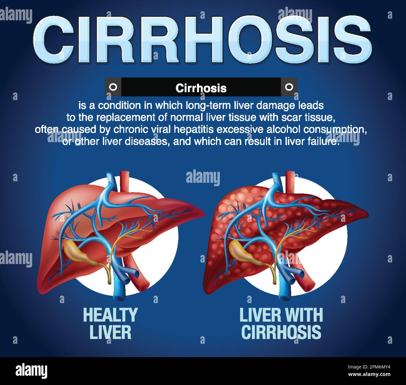 Cirrhosis Of The Liver Infographic Illustration Stock Vector Image And Art Alamy