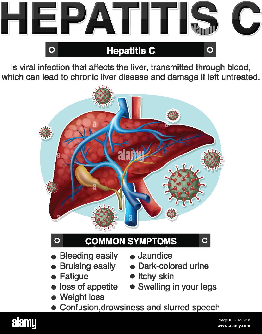 Symptoms of Hepatitis C Infographic illustration Stock Vector Image & Art - Alamy