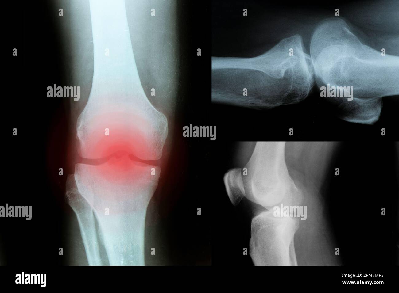 X-ray of a patient with a torn meniscus of the knee joint in a man and ...