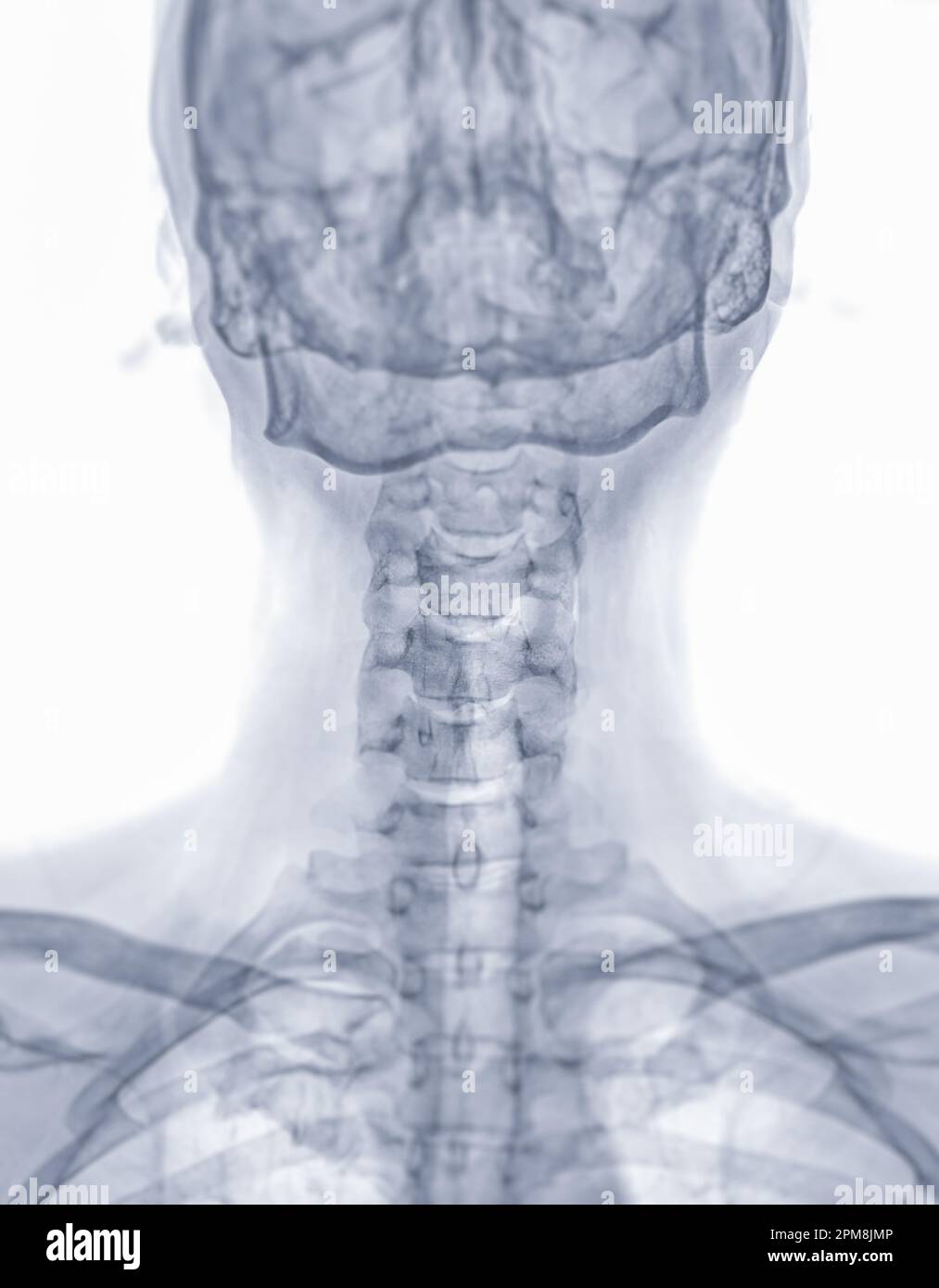 X-ray C-spine or x-ray image of Cervical spine lateral view for ...