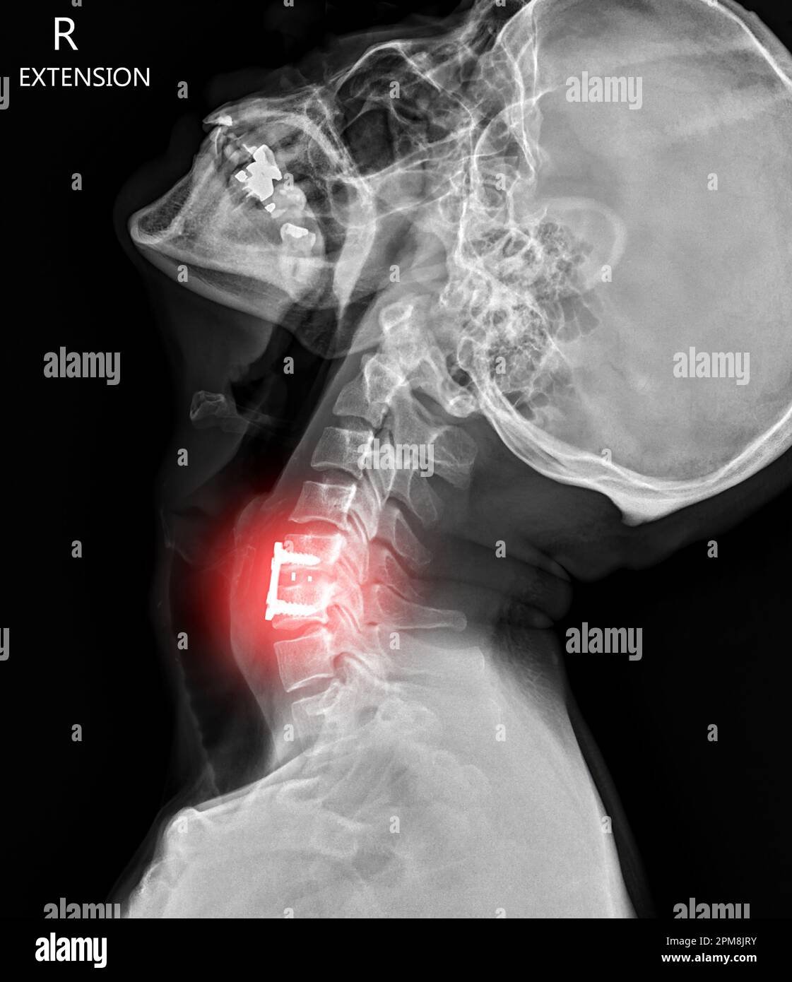 X-ray C-spine or x-ray image of Cervical spine lateral view showing ... X-ray C-spine or x-ray image of Cervical spine lateral view showing ...