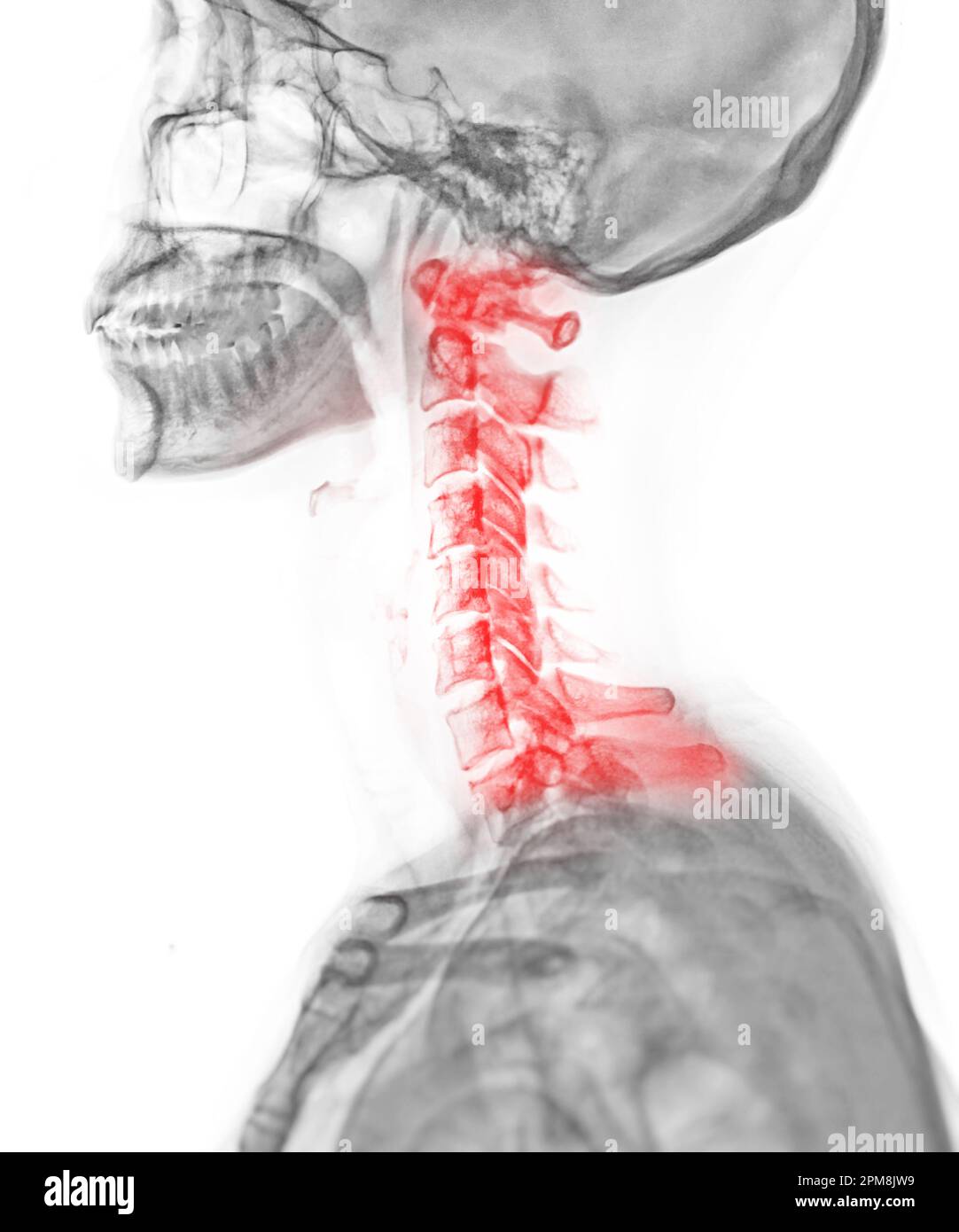 X-ray C-spine or x-ray image of Cervical spine lateral view for ...