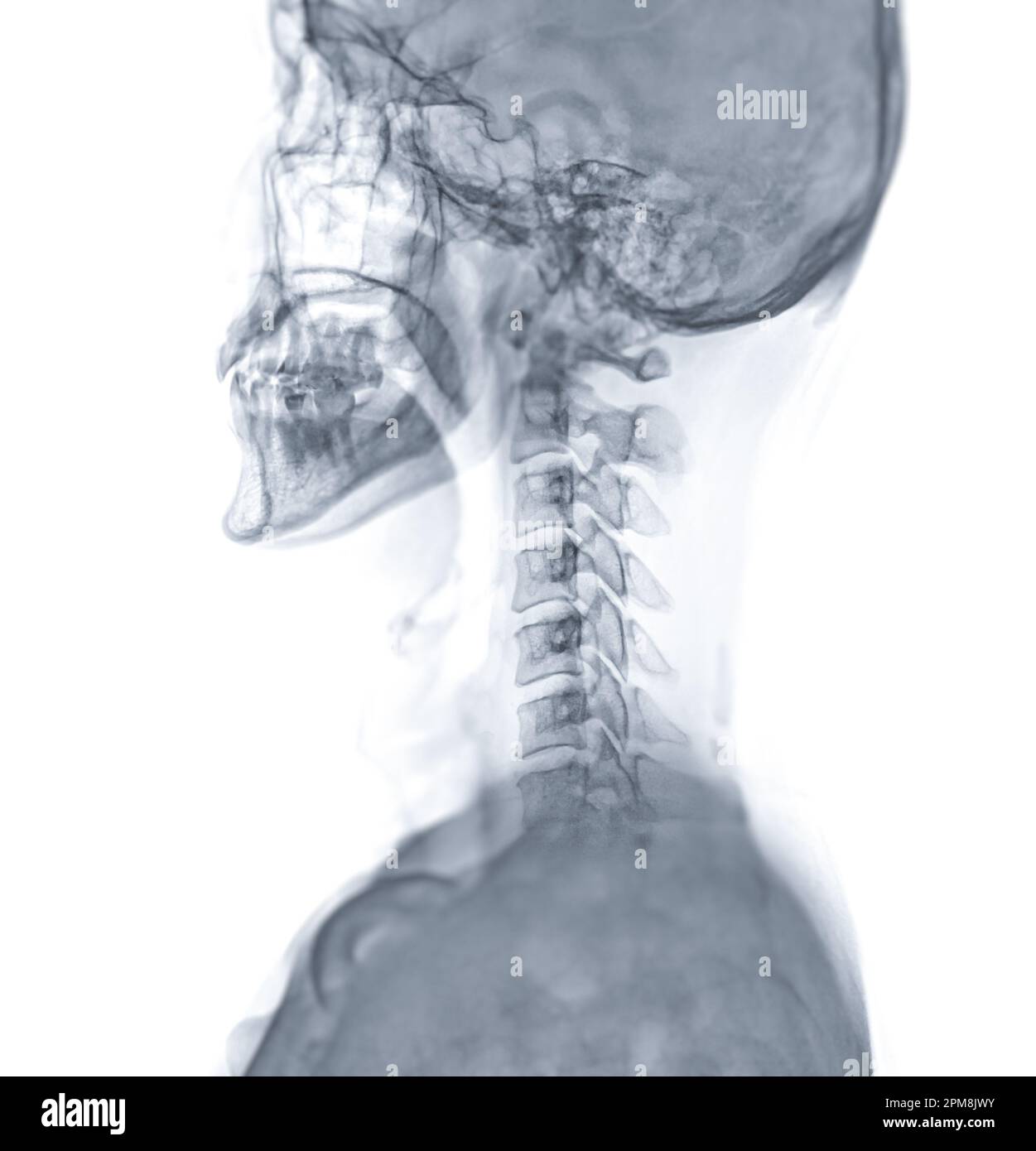 X-ray C-spine or x-ray image of Cervical spine lateral view for ...