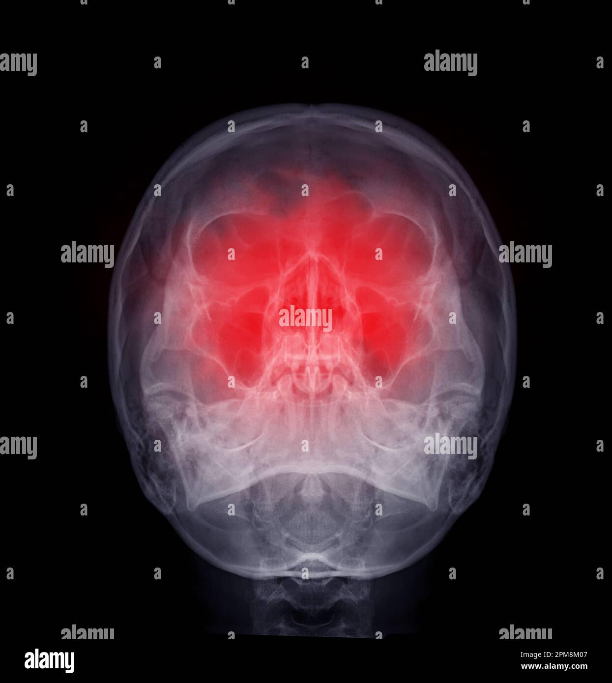 Skull Fracture X Ray Diagnosis at Booker Zuniga blog