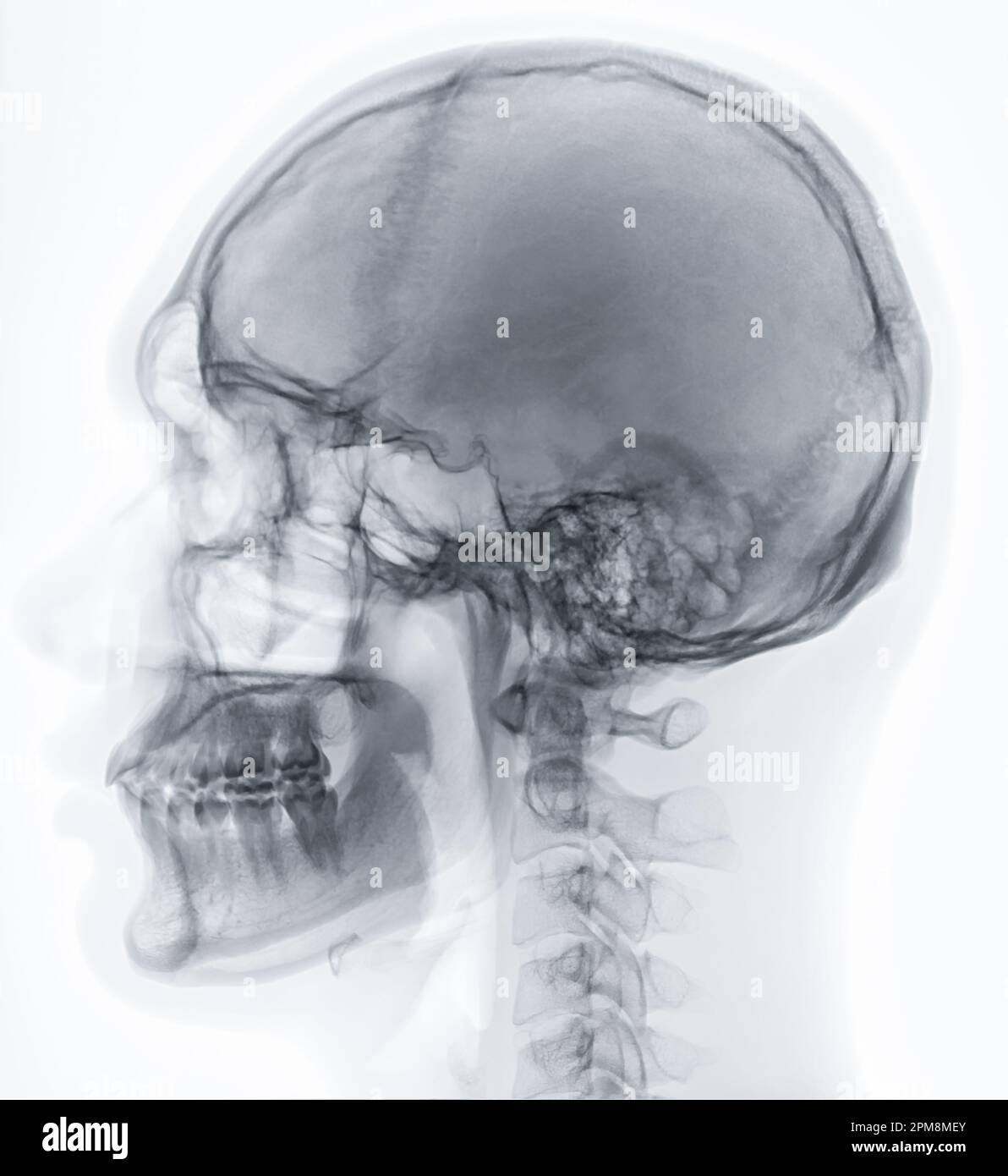 x-ray image of Human Skull lateral view for diagnosis skull fracture ...