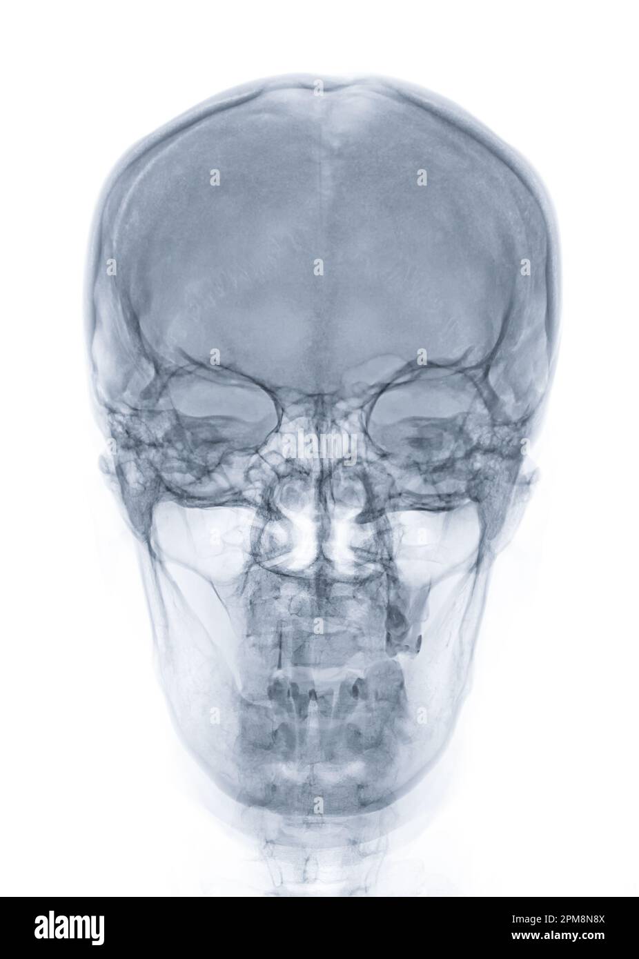 Skull Fracture X Ray Diagnosis at Booker Zuniga blog