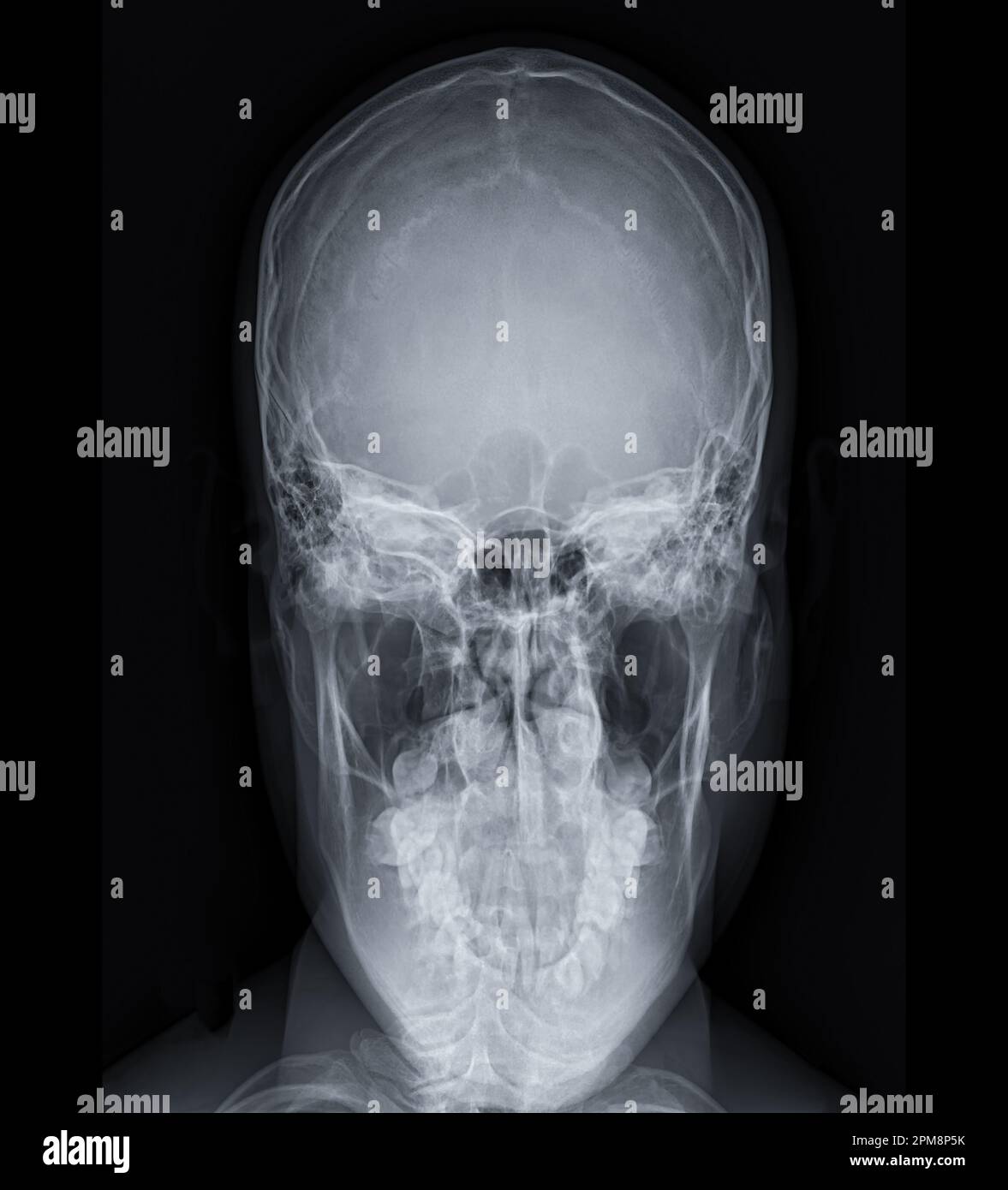X Ray Skull Towns View