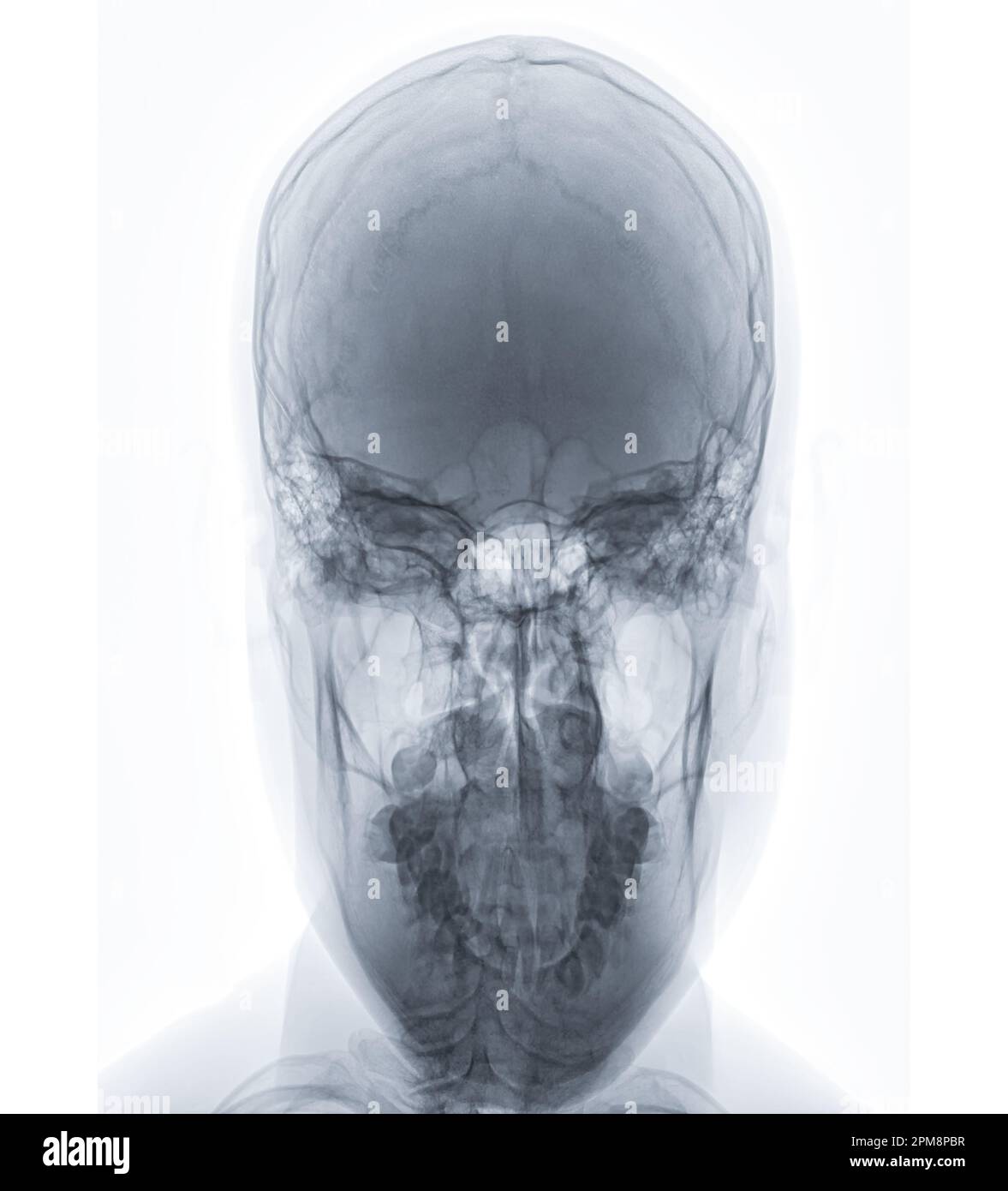 X Ray Skull Towns View Cephalometric X Rays (also Called Ceph X Rays