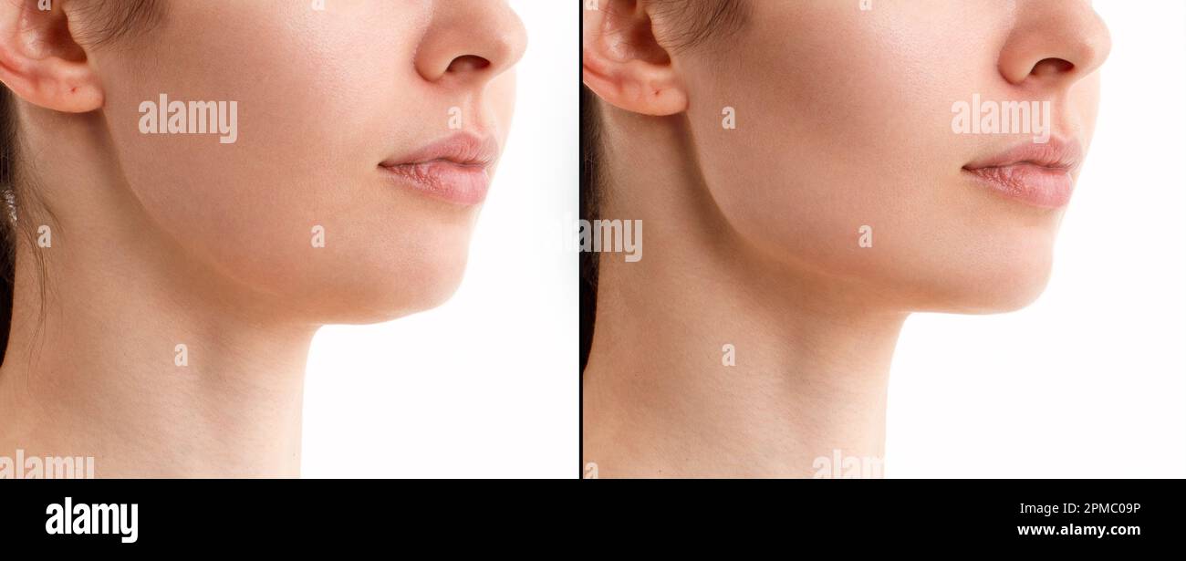 A close portrait of a woman before and after the facial rejuvenation ...