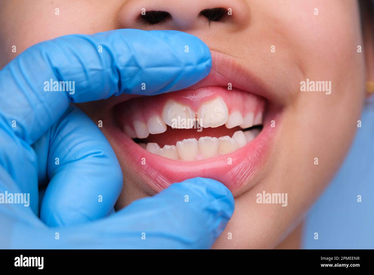 Wide Open Mouth Revealing Teeth Tongue Palate And Uvula