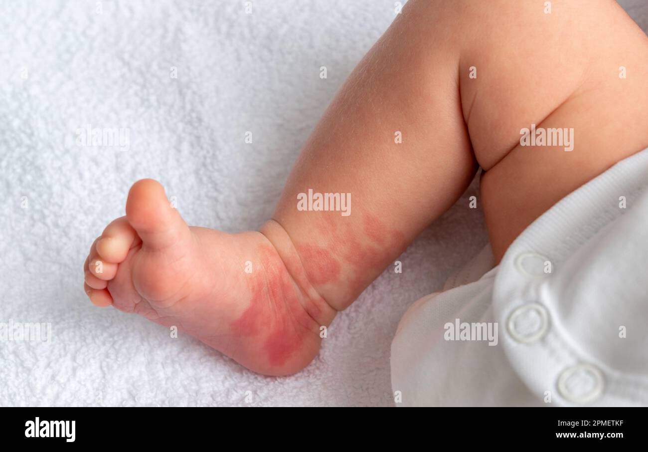 Hemangioma red birthmark on the leg of newborn baby Stock Photo - Alamy