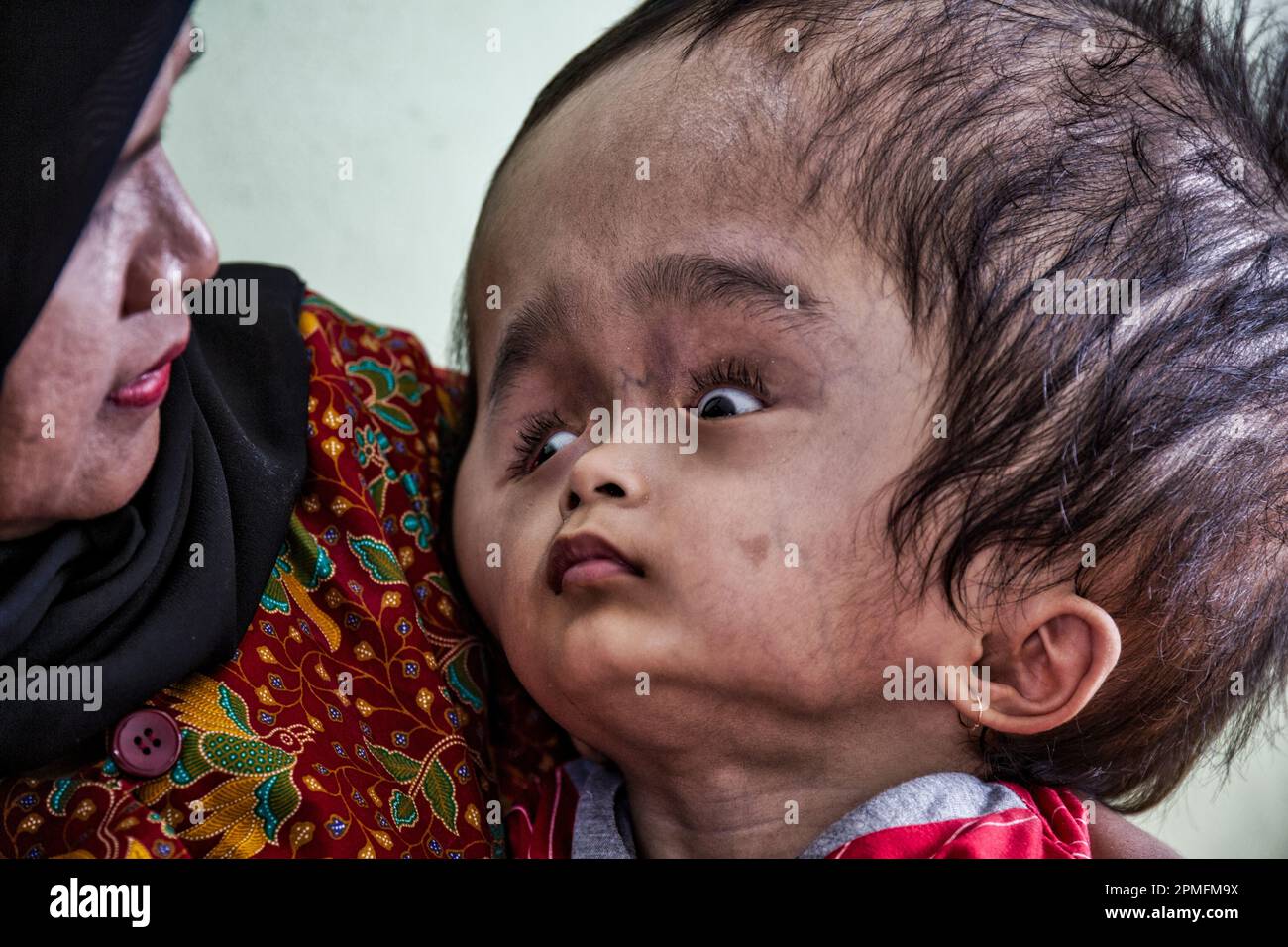 Hydrocephalus in java hi-res stock photography and images - Alamy