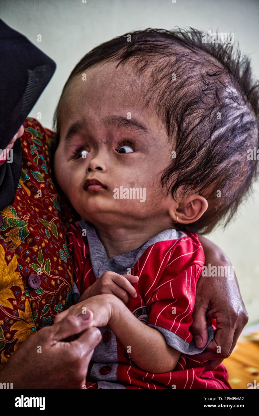 Hydrocephalus cerebrospinal fluid hi-res stock photography and images ...