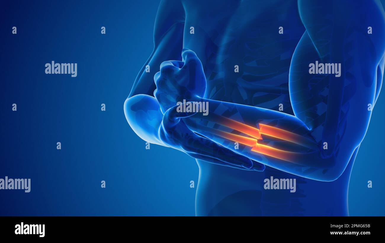 Broken hand bone pain medical concept Stock Photo - Alamy