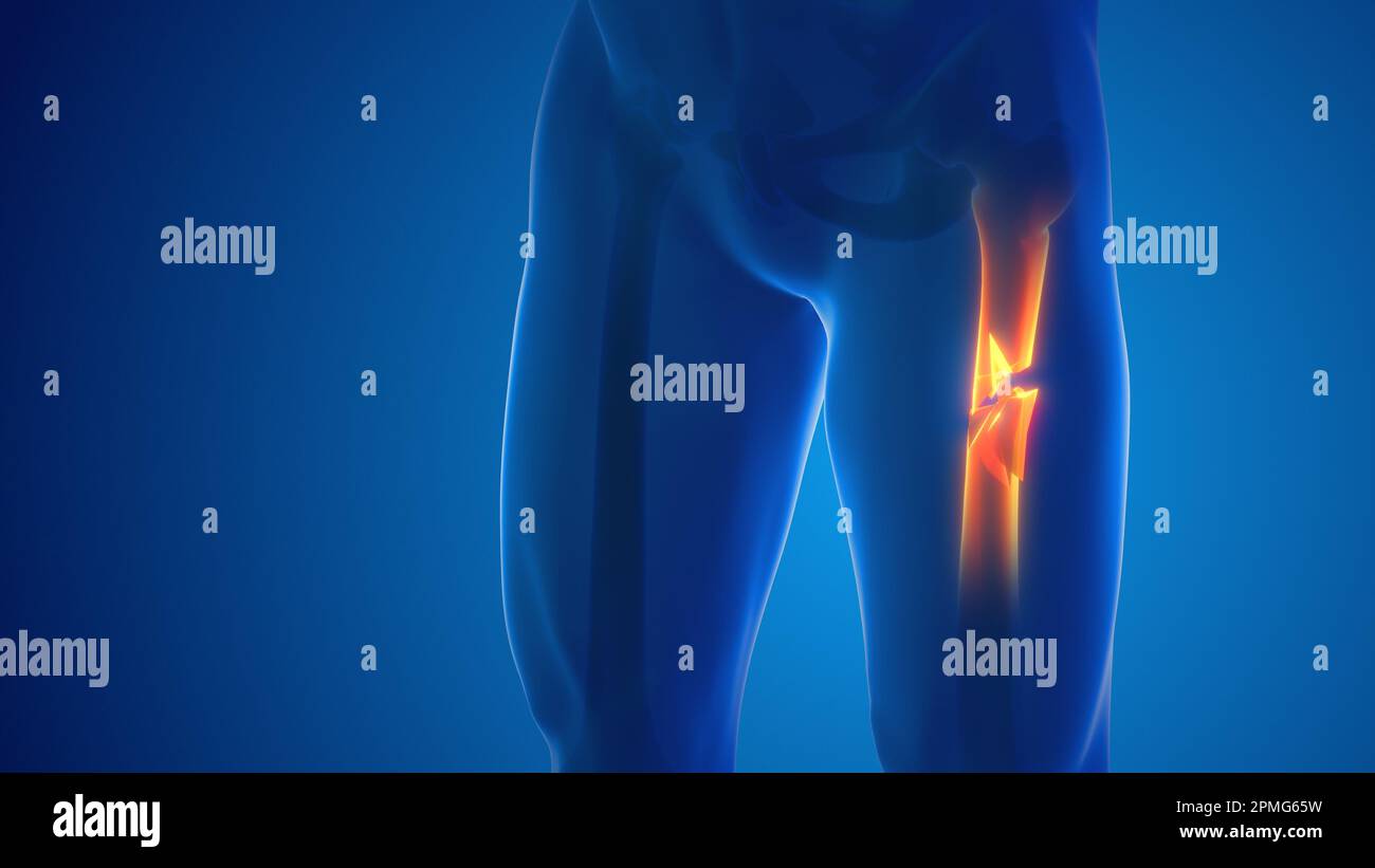 Broken leg Femur bone pain medical concept Stock Photo - Alamy