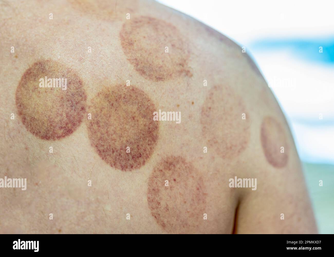 Circular bruises on a back and shoulder after cupping therapy Stock ...