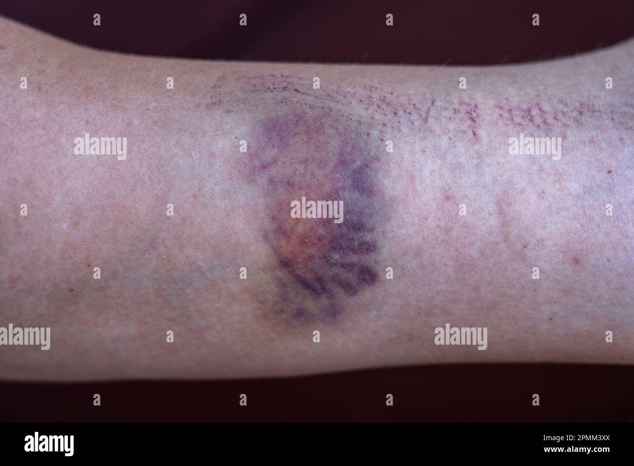 Purple bruise on the skin on a woman hand, close up Stock Photo - Alamy