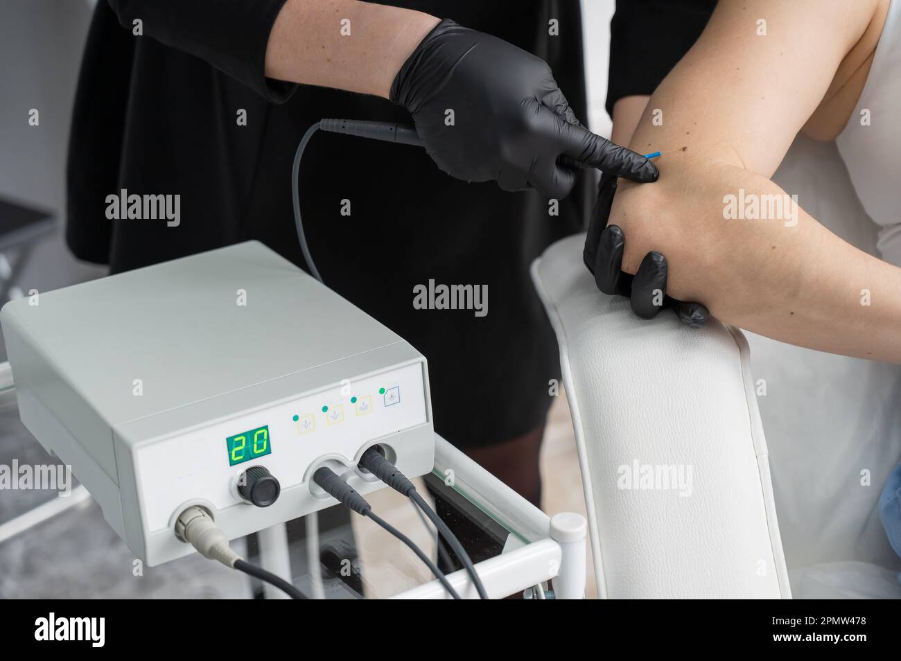 Dermatologist removes a mole on a patient's arm using an ...