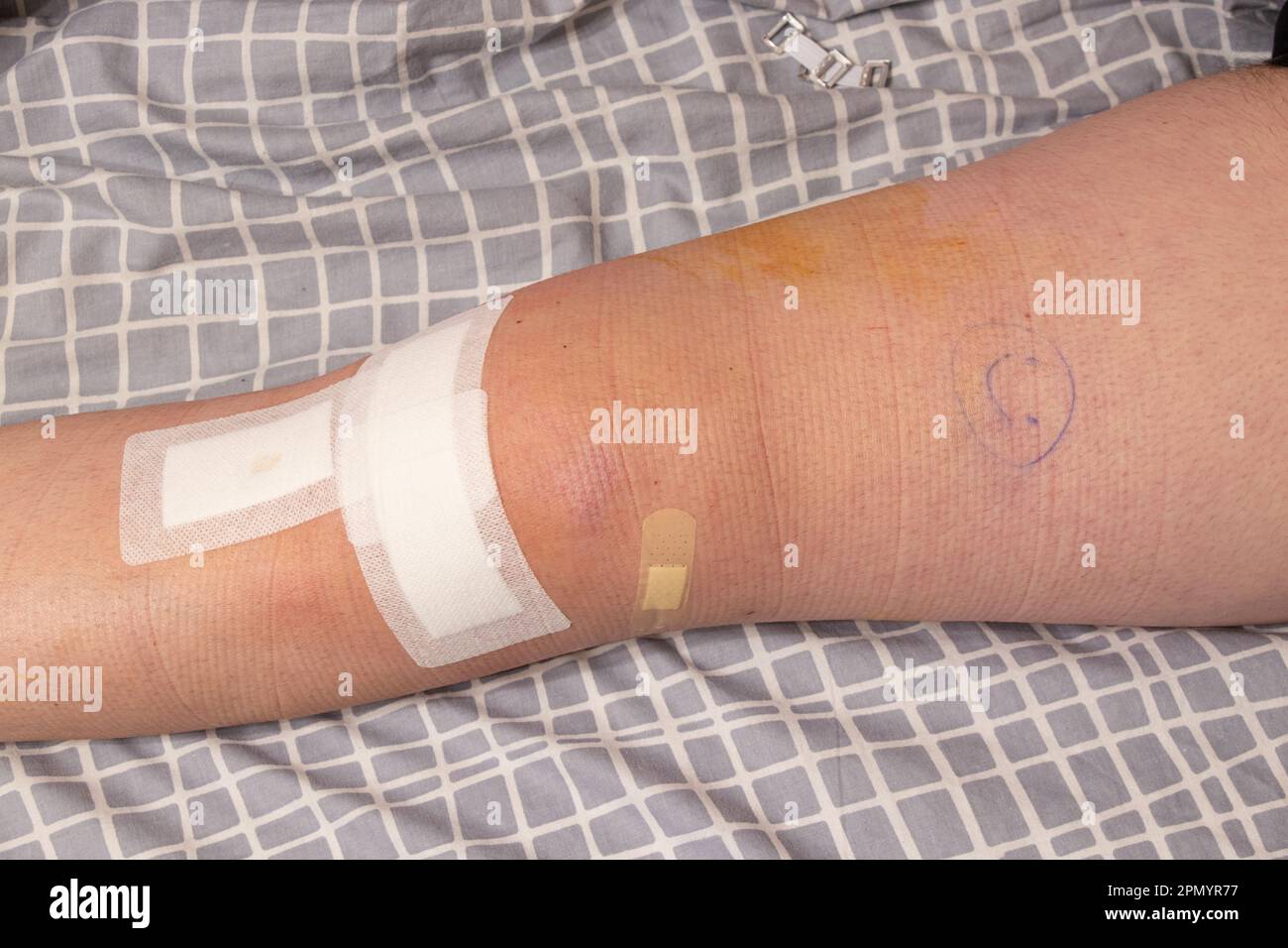 Human leg with adhesive tape after knee surgery on the bed, leg Stock ...