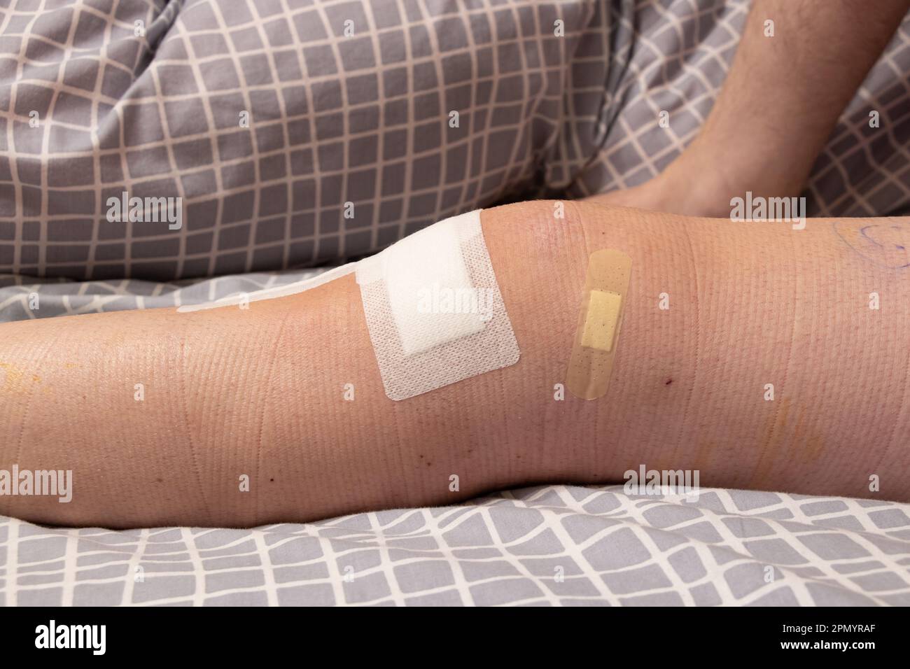Human leg with adhesive tape after knee surgery on the bed, leg Stock ...