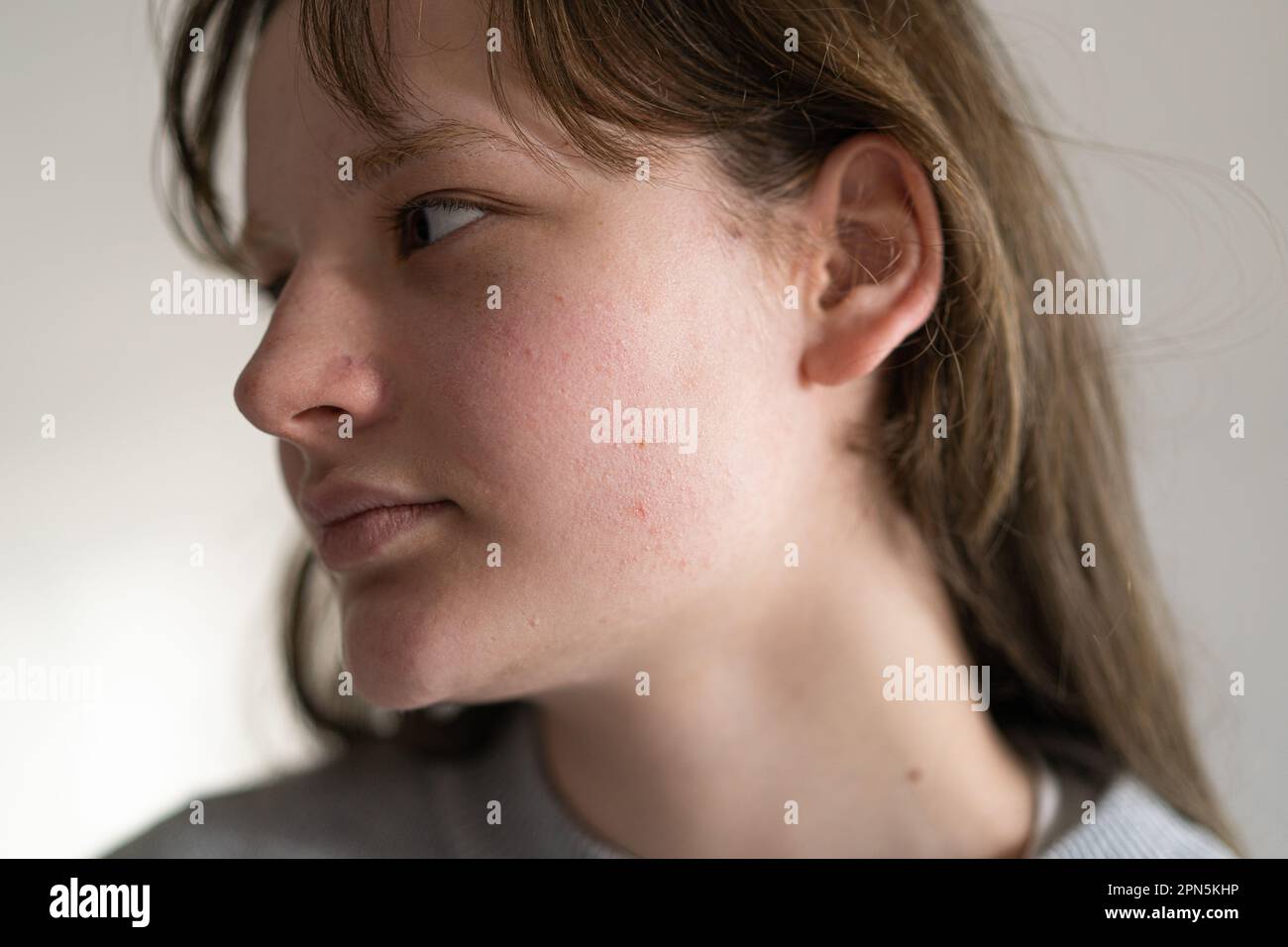 Problem skin face. A teenage girl with a troubled face Stock Photo - Alamy