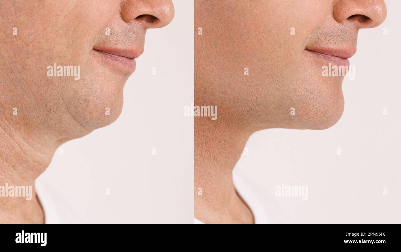 A close portrait of an aged man before and after the facial ...