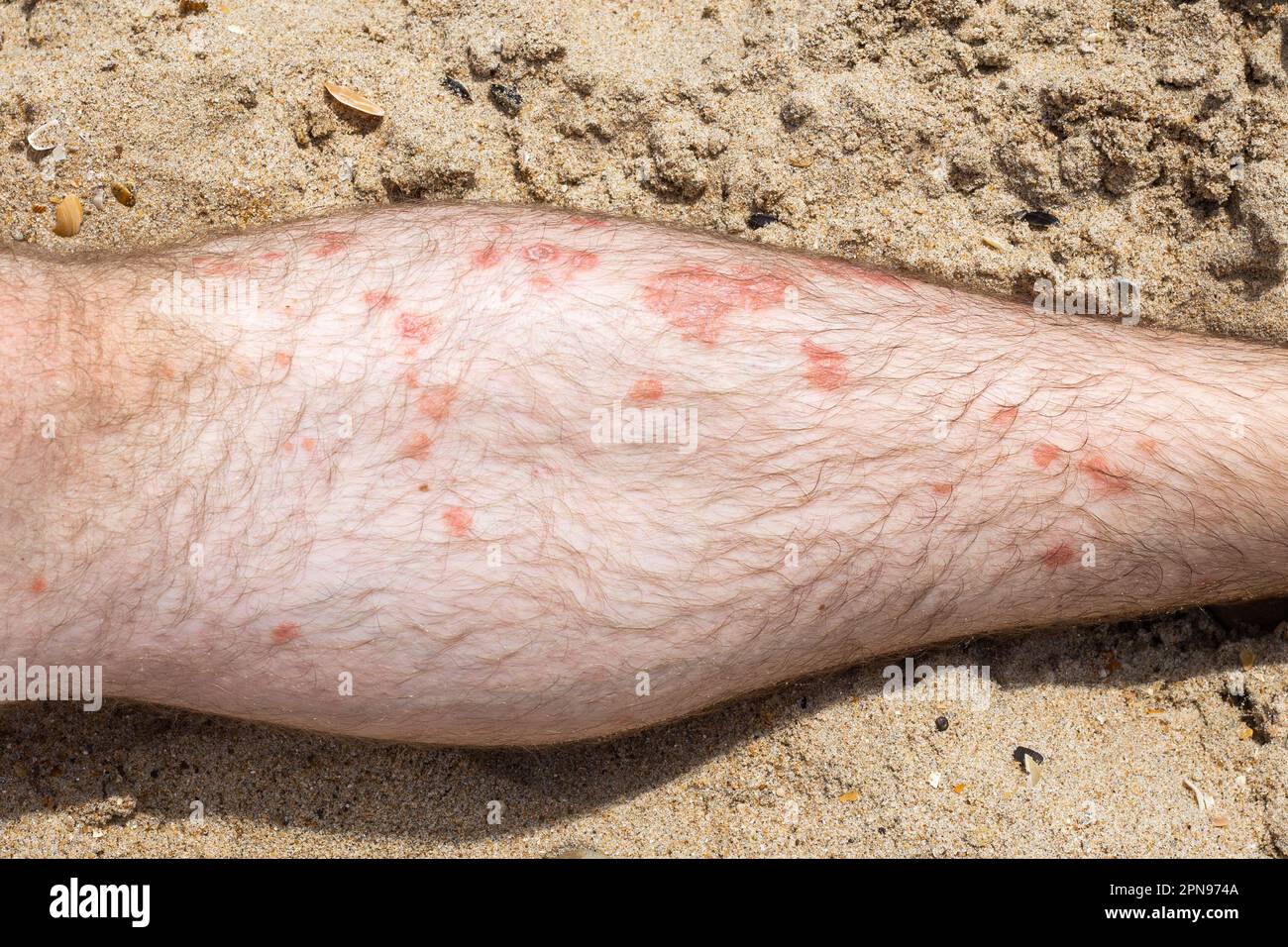 many red, scaly ulcers on a man's leg. Immune disease psoriasis and UV ...