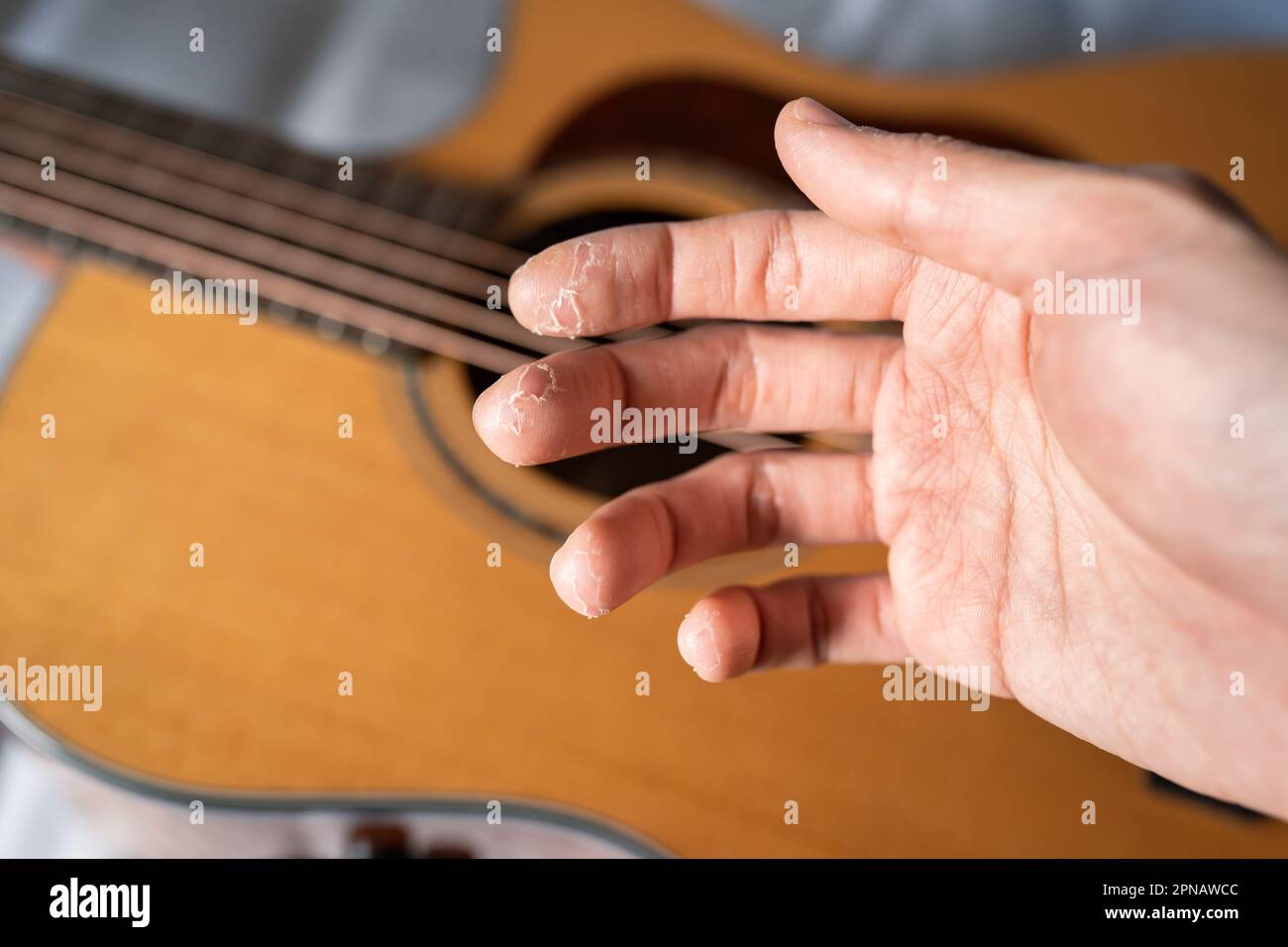 Guitarist's hand with peeling skin Stock Photo - Alamy