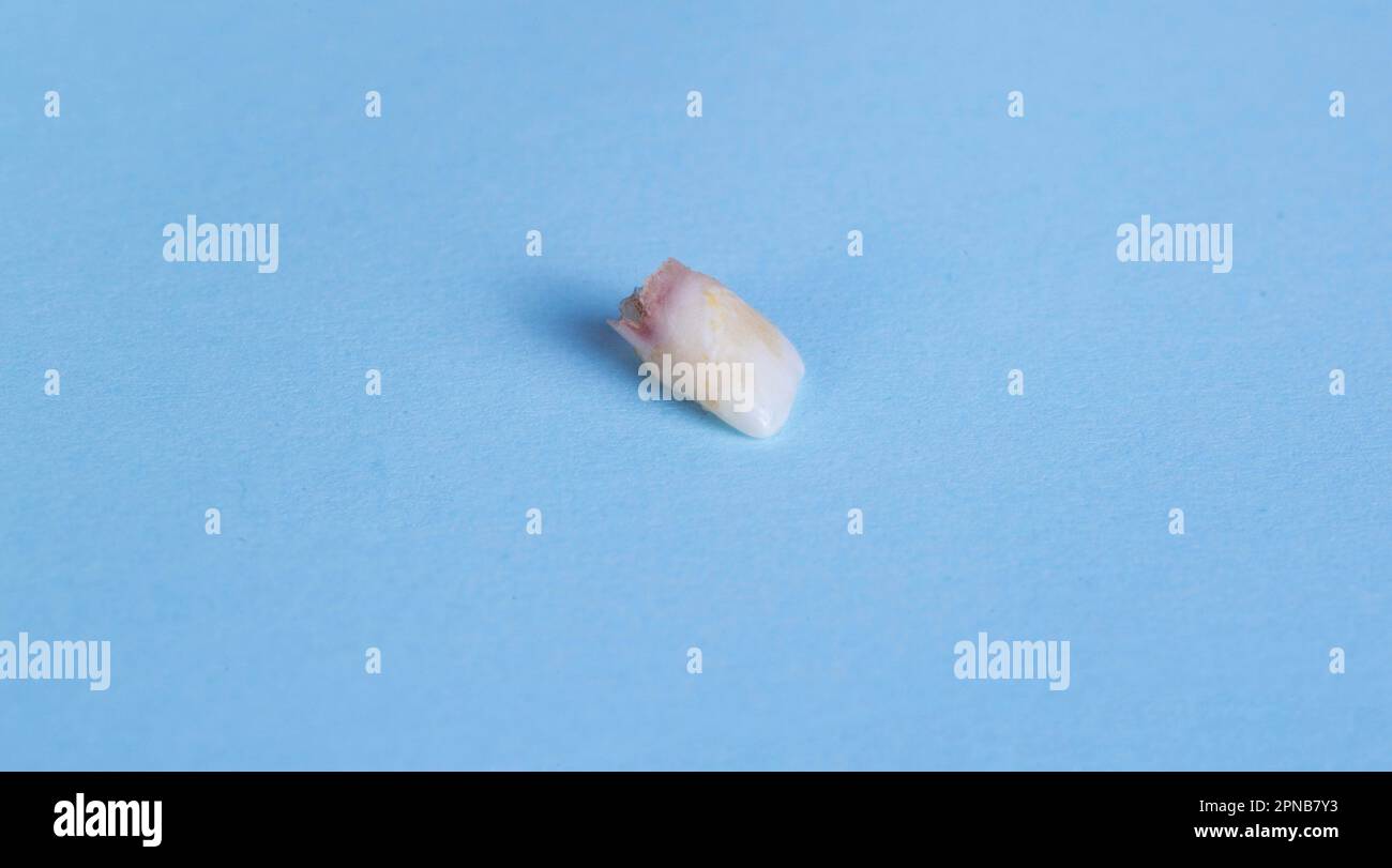 Children's milk tooth on a blue background. The concept of tooth ...