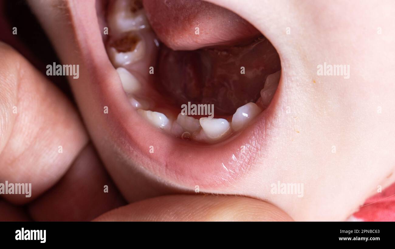 Uneven teeth hi-res stock photography and images - Alamy