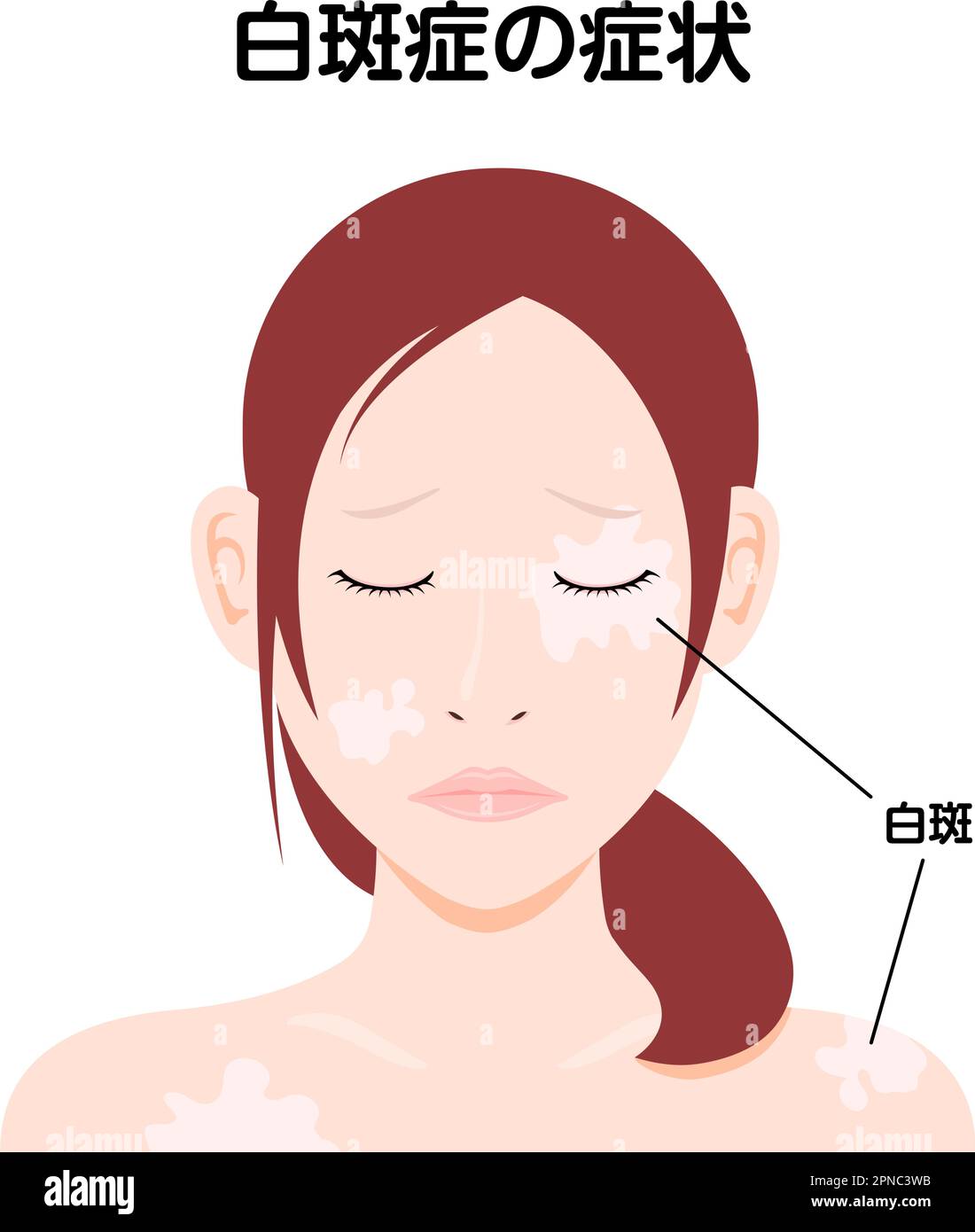 Symptoms of Vitiligo vector illustration Stock Vector Image & Art - Alamy