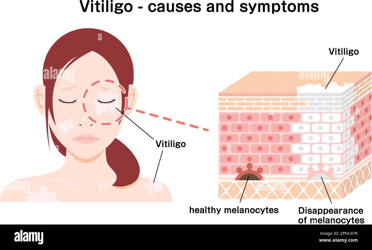 Causes and symptoms of Vitiligo vector illustration Stock Vector Image & Art - Alamy