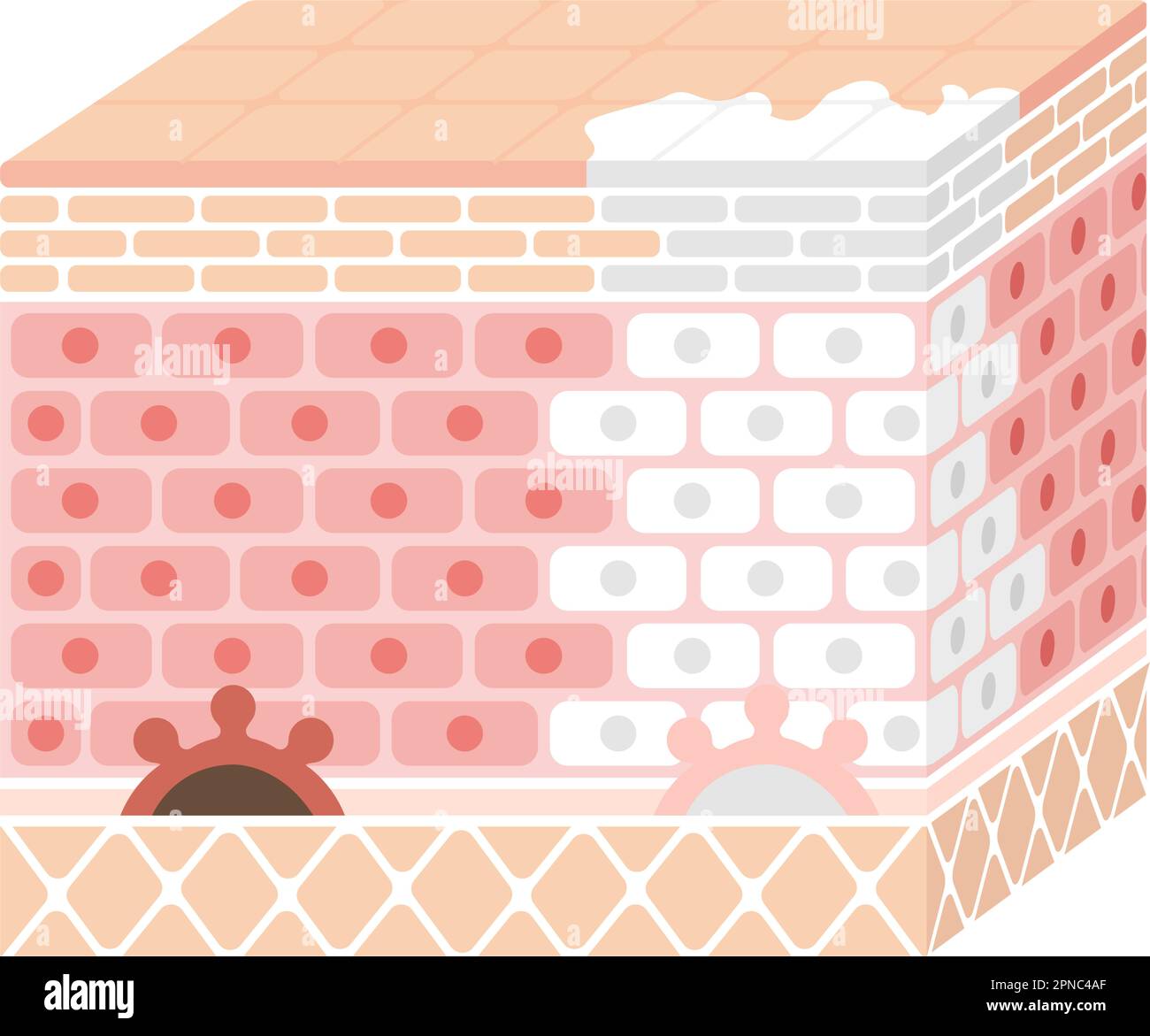 Causes and symptoms of Vitiligo vector illustration Stock Vector Image ...