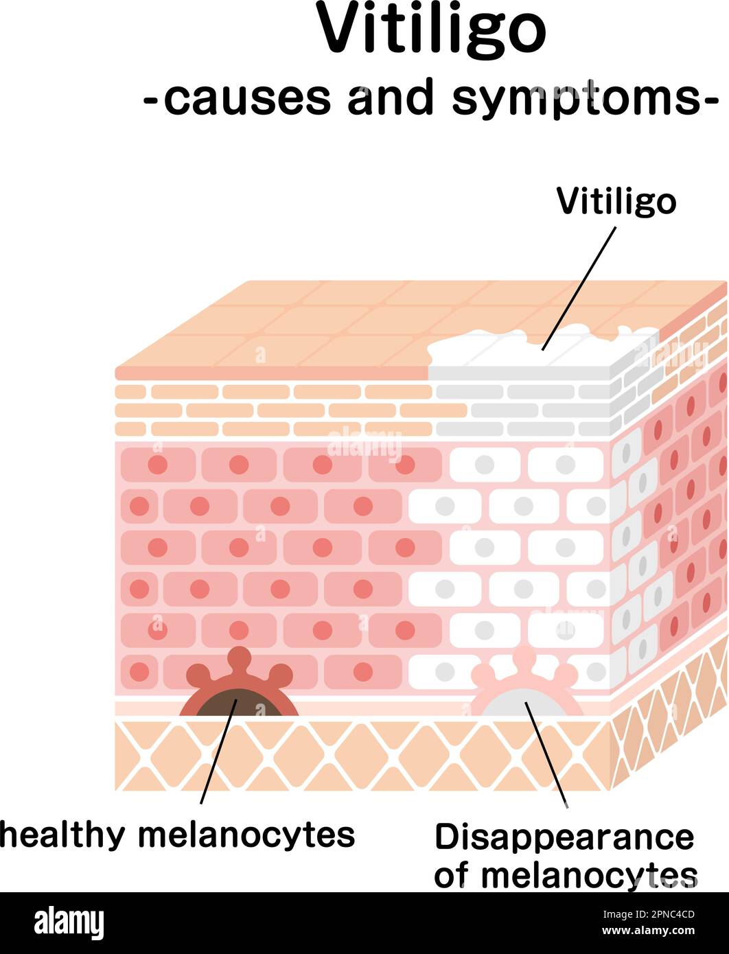 Skin, pigment, problem Stock Vector Images - Alamy